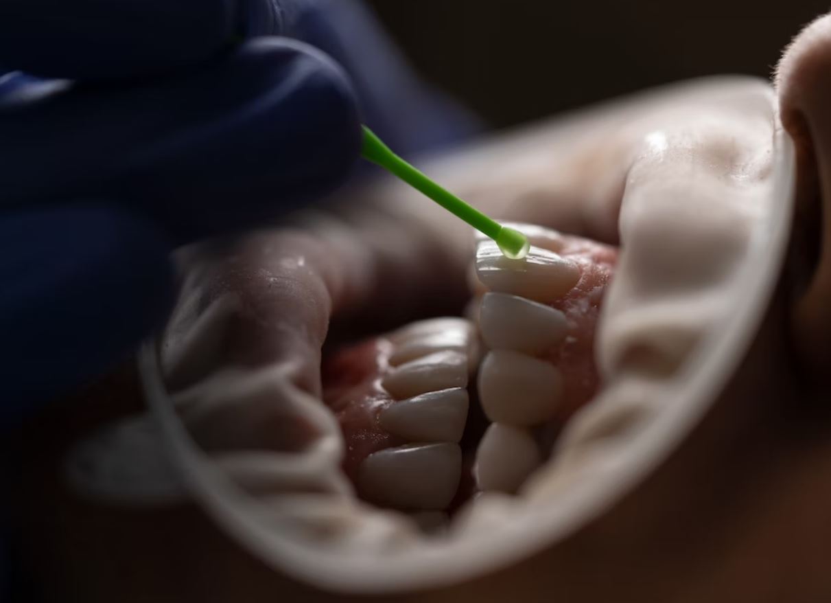 ¿Por qué aparecen manchas en los dientes y cómo puedes eliminarlas? | Moons