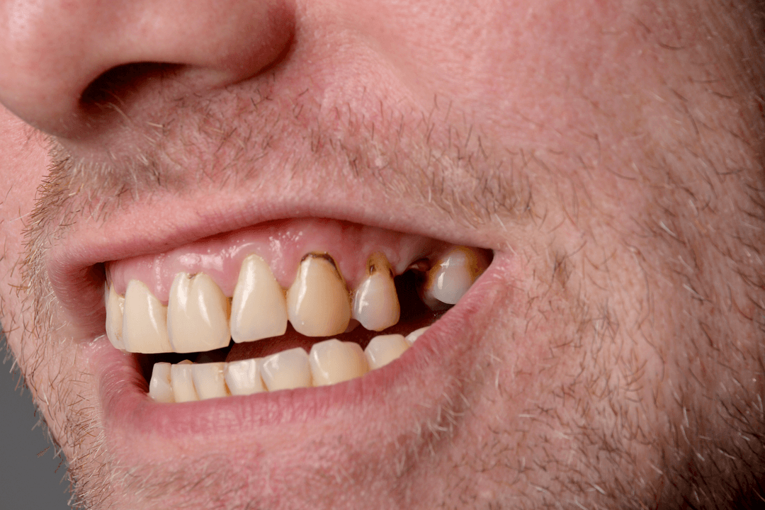 Dientes podridos: causas y tratamiento para esta afección | Moons