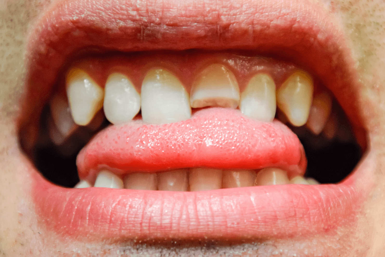 Diente astillado: síntomas, causas y tratamientos | Moons