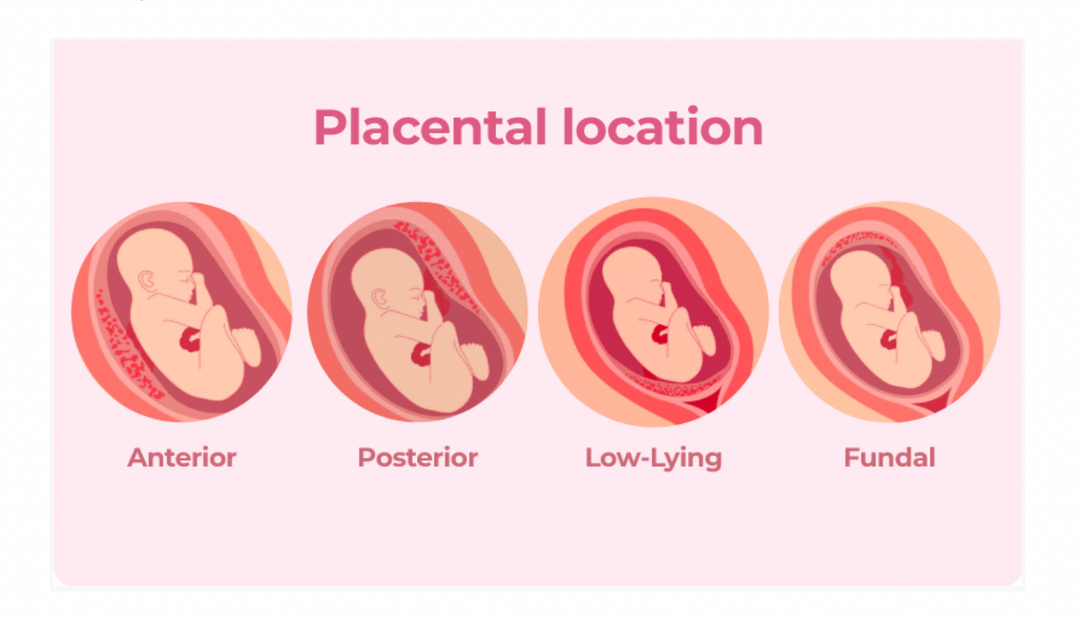 What Is a Circumvallate Placenta?