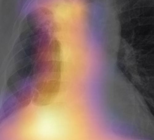 X-ray