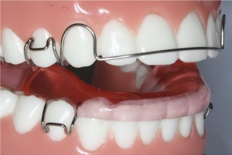 Functional Braces At Newpark Clinic Specialist Orthodontics South Dublin