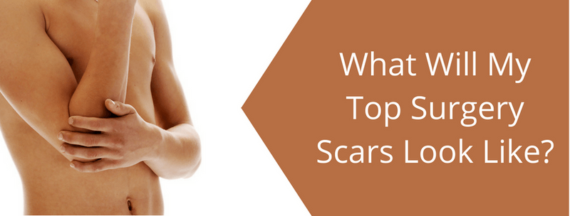 What Will My Top Surgery Scars Look Like Mclean Clinic
