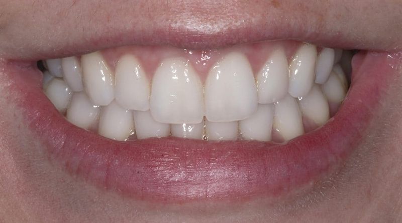 No-Prep Veneers in Cary, North Carolina