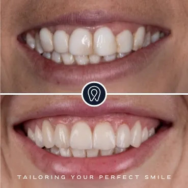 Dental Crowns Front Teeth Treatment | Sydney Smile Doctor