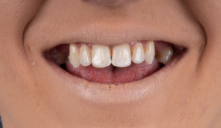 After & Before Photos Gallery | Sydney Smile Doctor