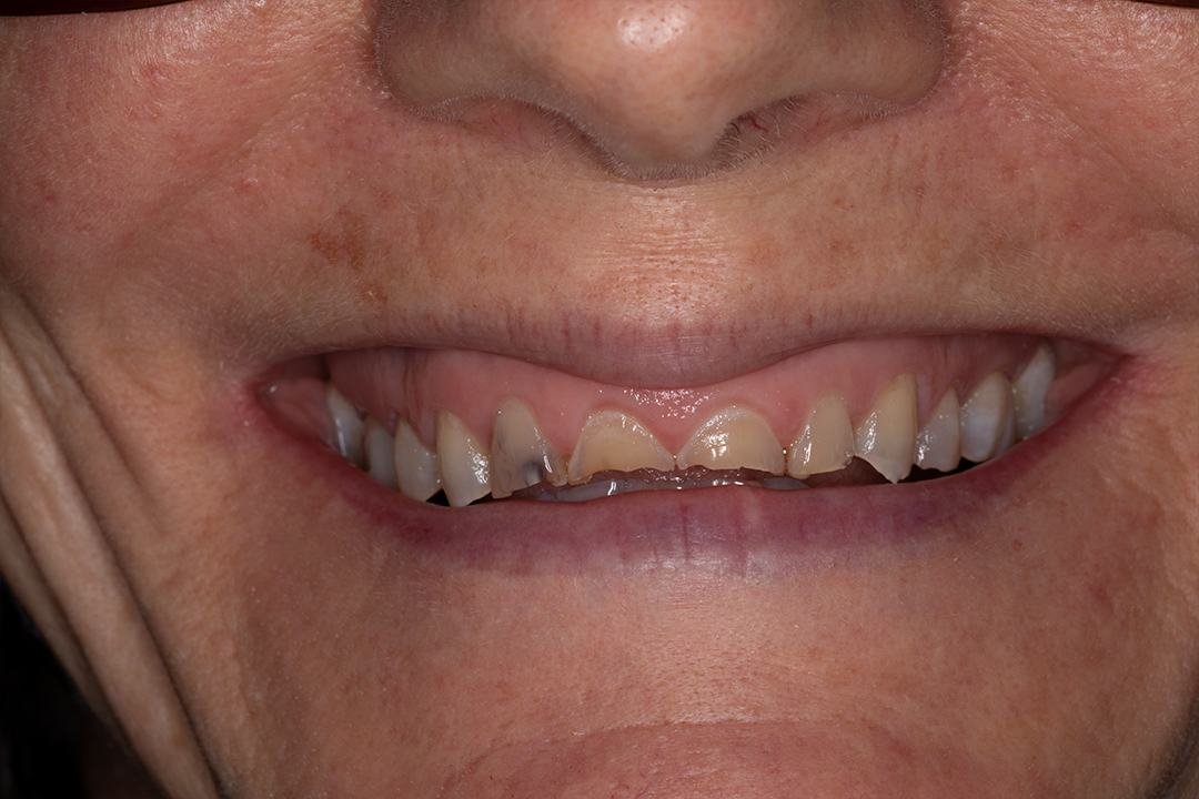 What are Porcelain Veneers? | Sydney Smile Doctor