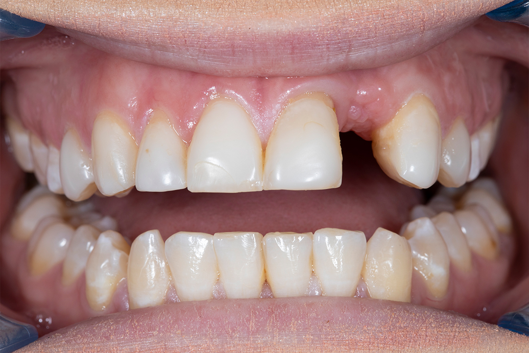 Tooth Replacement: Treatment Options and Costs | Sydney Smile Doctor