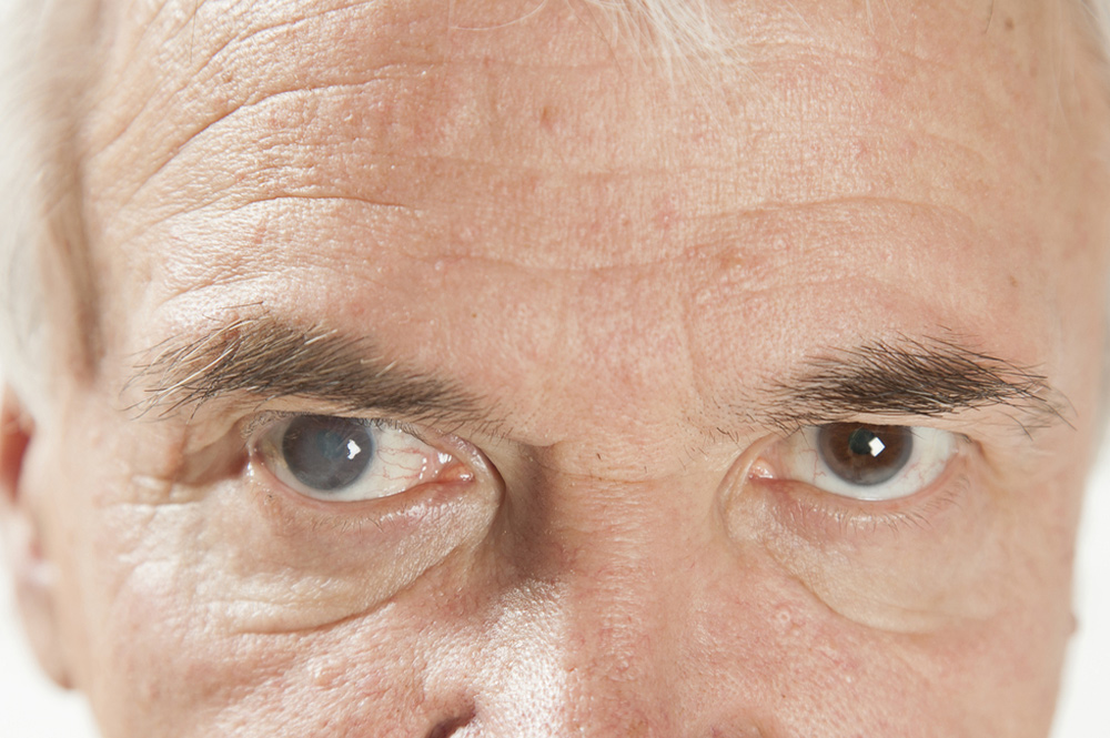 What Is The First Sign Of Cataracts? | West Boca Eye Center