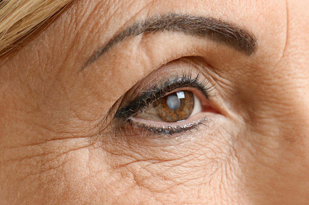 What Causes Cataracts In Humans? | West Boca Eye Center
