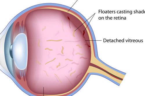 Can A Floater In The Eye Be Removed? | West Boca Eye Center