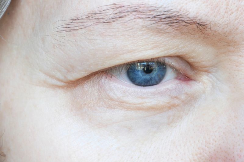 What Causes Ptosis and How is it Corrected? | West Boca Eye Center