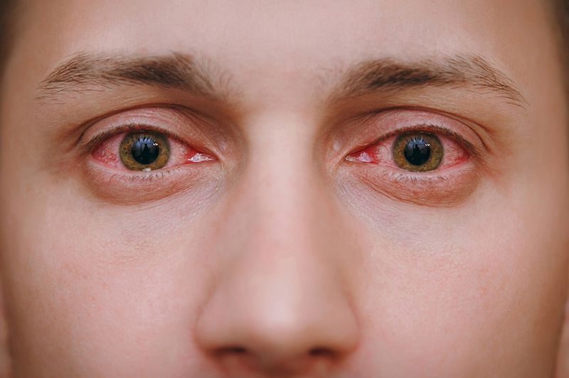 Red Eyes After Cataract Surgery | West Boca Eye Center