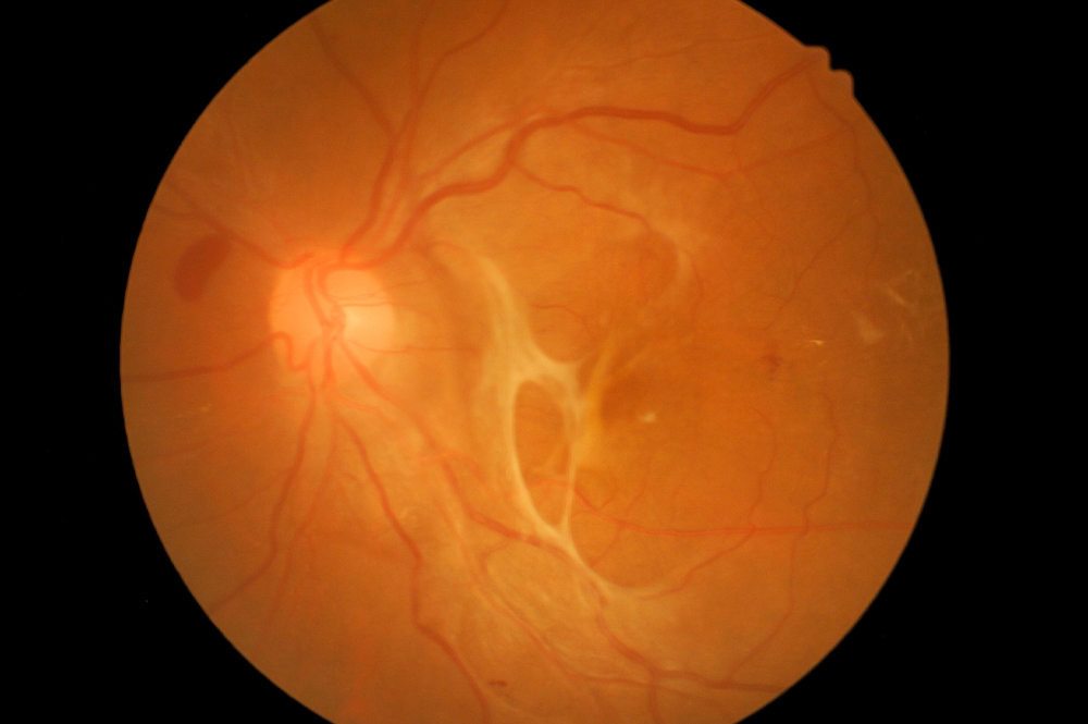 What is Tractional Retinal Detachment? | West Boca Eye Center