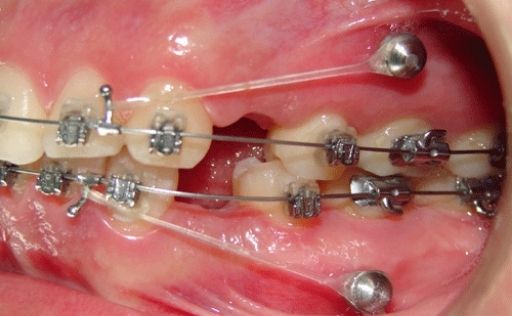 ¿Qué son los microimplantes dentales para ortodoncia? - Branz Ortodoncia