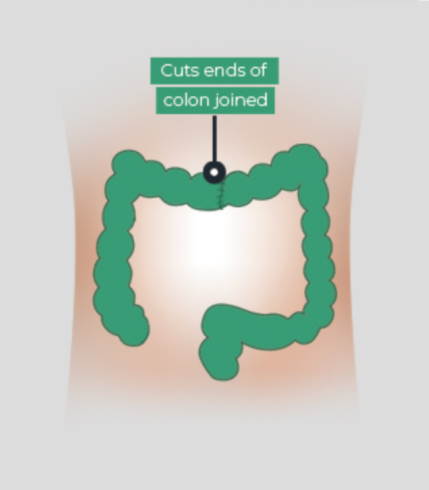 Colorectal surgery