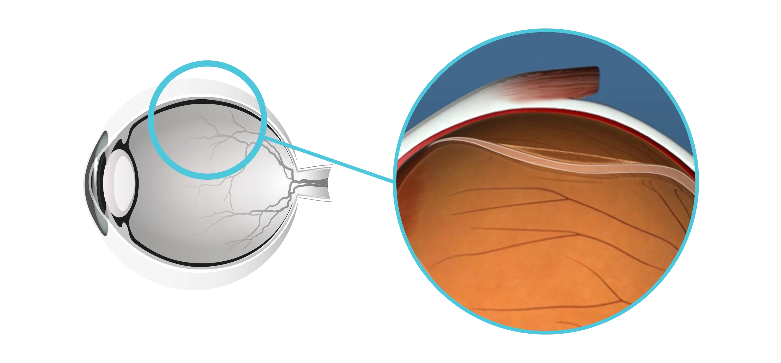 Distacco di Retina - STAR 9000 | Brescia