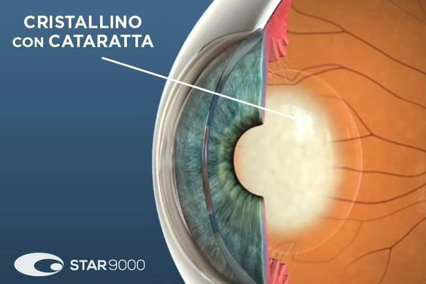 Cataratta, di cosa si tratta e come si risolve il problema - STAR 9000 ...