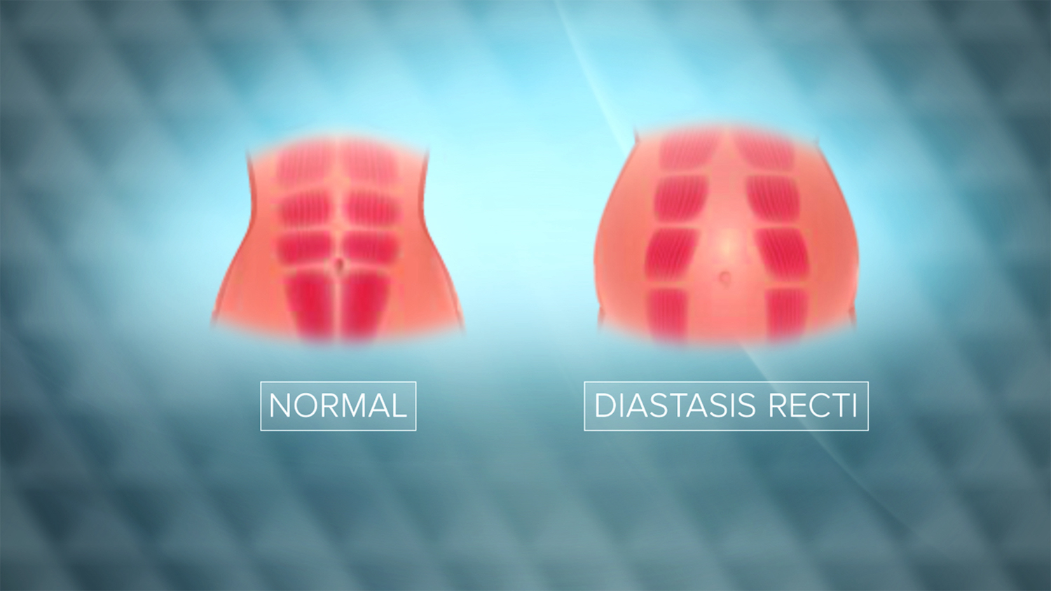 Diastasis Recti The Today show | Baby Bod Online | Prenatal Postpartum ...