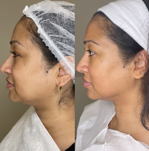 Soft Jawline Treatments Liverpool | Model Standards