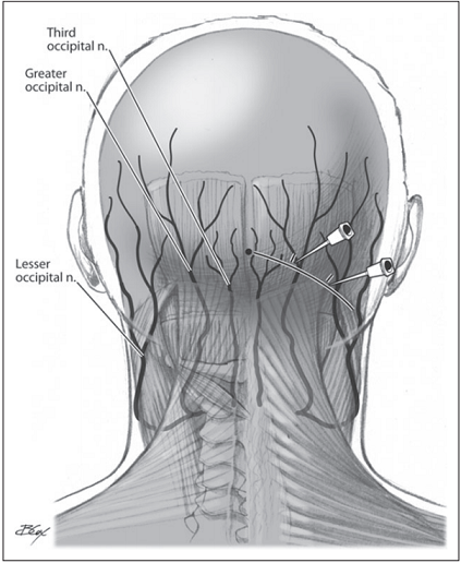 Occipital nerve pain | Patient information sheets