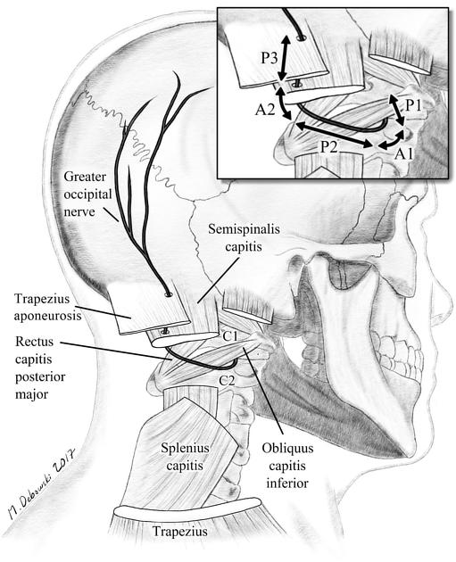 Occipital nerve pain | Patient information sheets