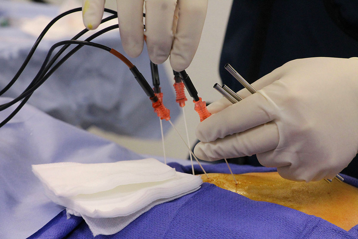 Radiofrequency ablation | Patient information sheets