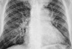 The Health Risks of Asbestos - Southeast Environmental