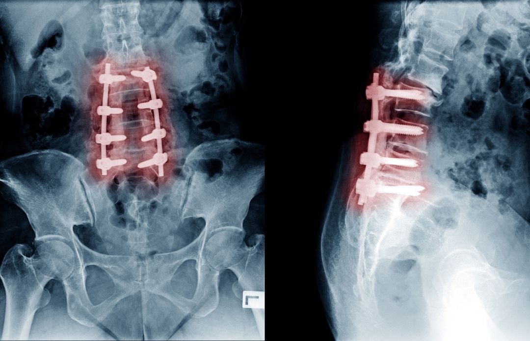 What Is Post Laminectomy Syndrome? | Carda Health
