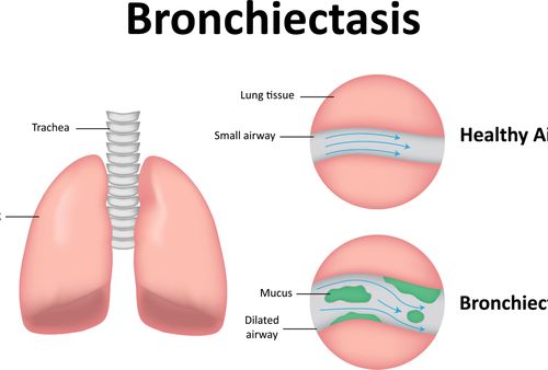 What Is Bronchiectasis? | Carda Health