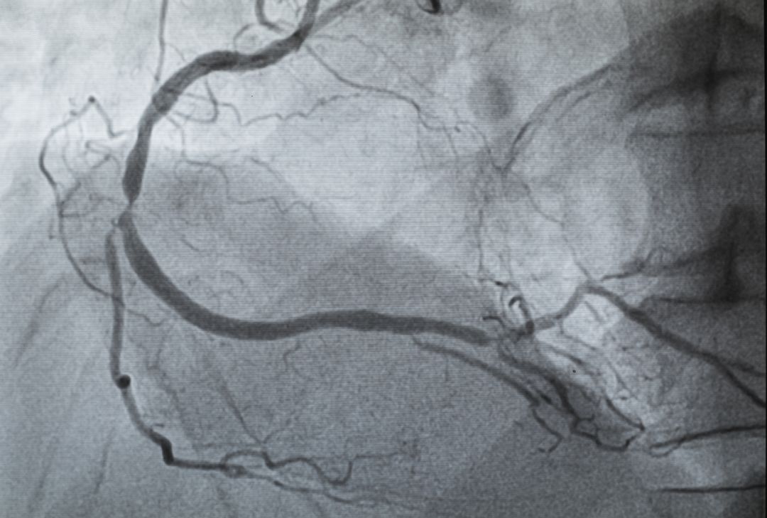 What Is an Angiogram? | Carda Health