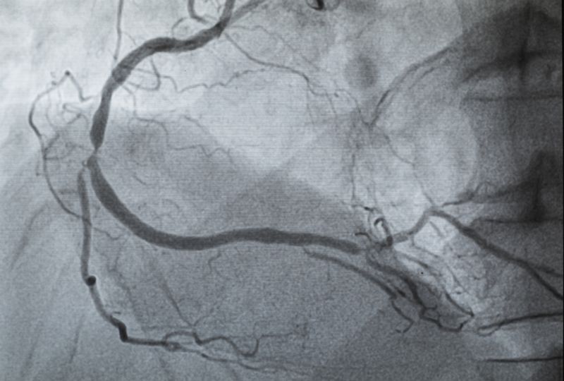 What Is an Angiogram? | Carda Health