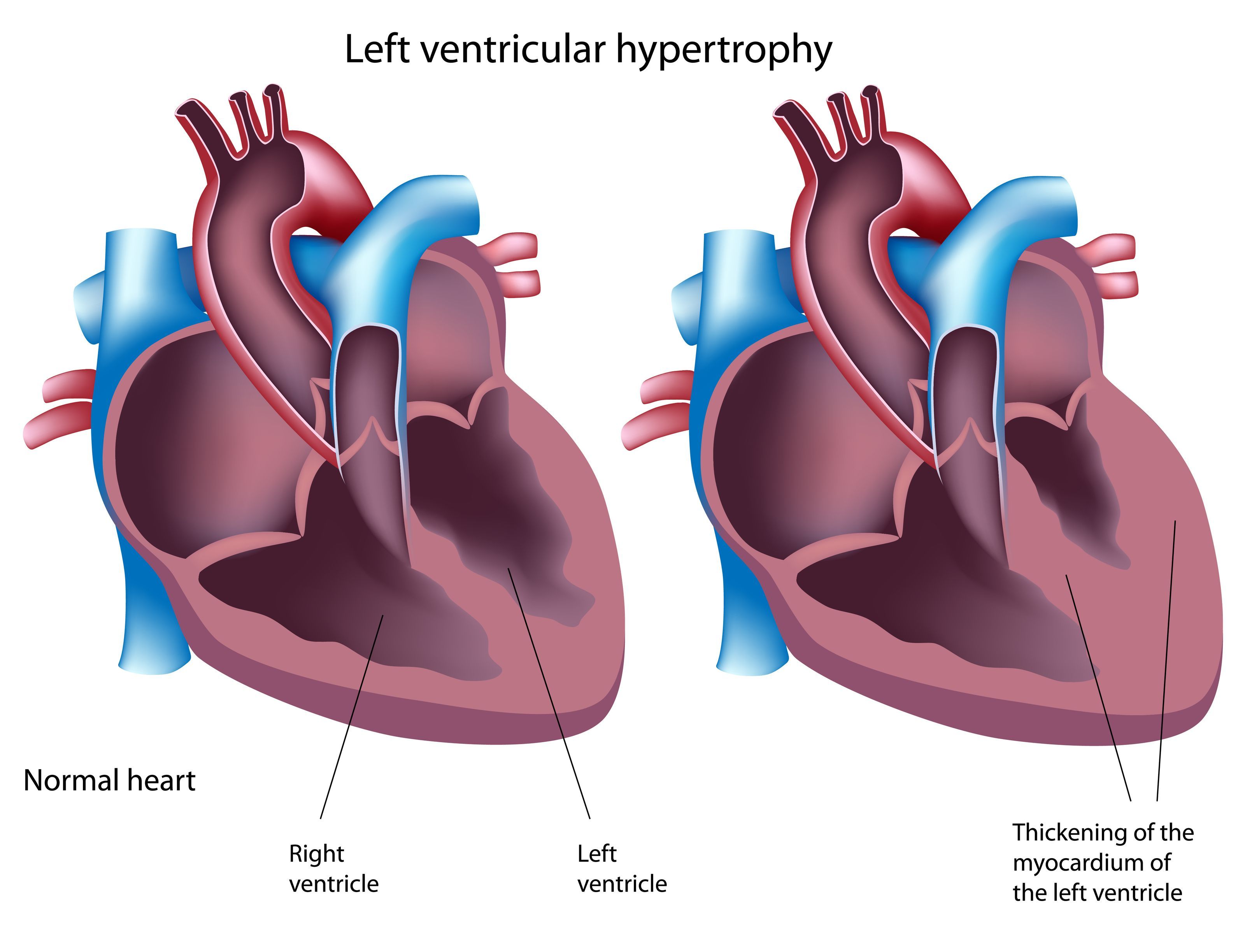 What Is Left Ventricular Hypertrophy? | Carda Health