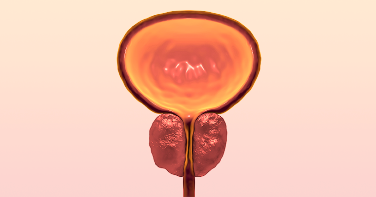 Benign Prostatic Hyperplasia (BPH) - Symptoms, Diagnosis & Treatment ...