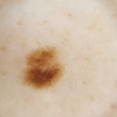 What's a Clark's nevus?