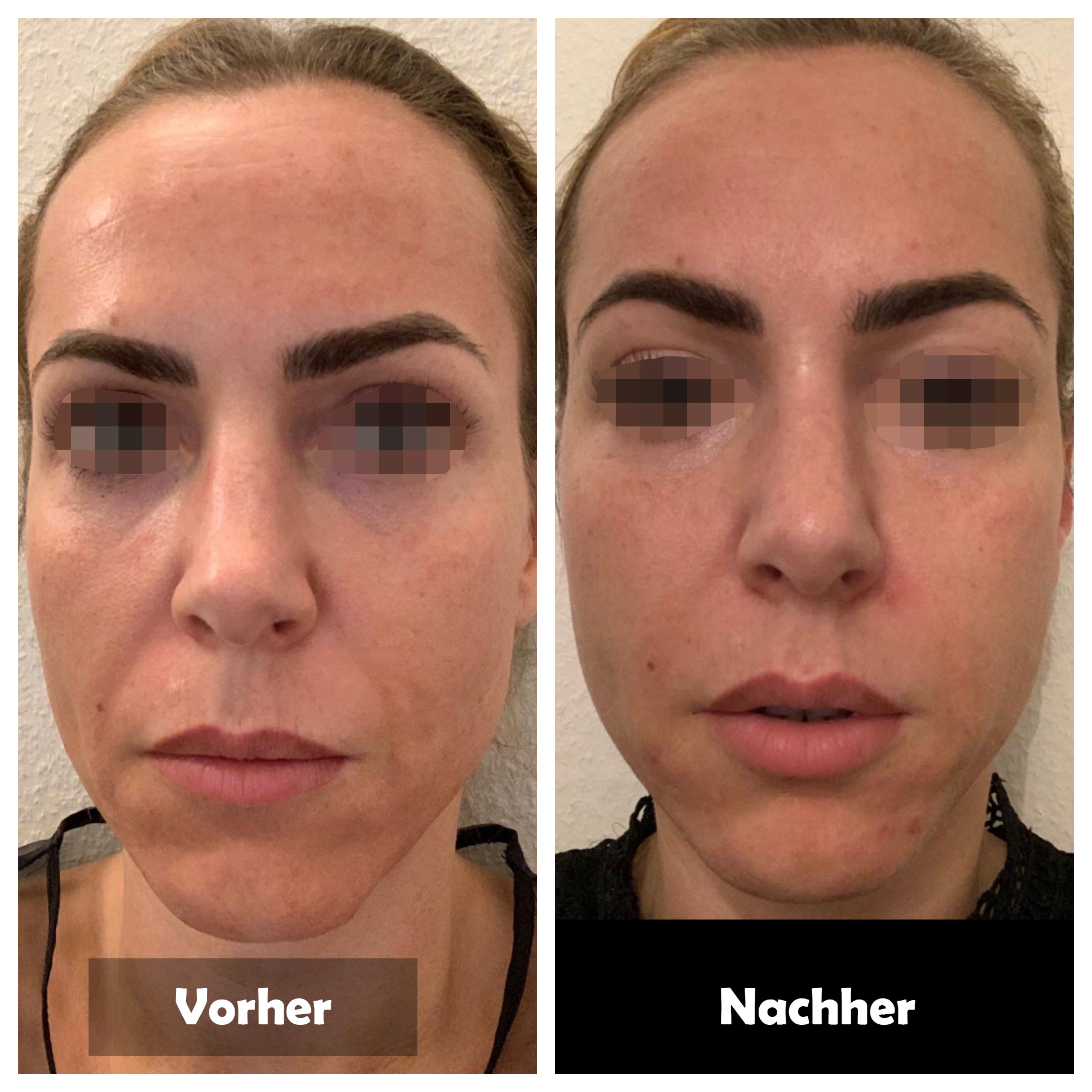 Willkommen bei OM Skincare - Ihre Plasma Behandlungen mit PRP Vampire ...