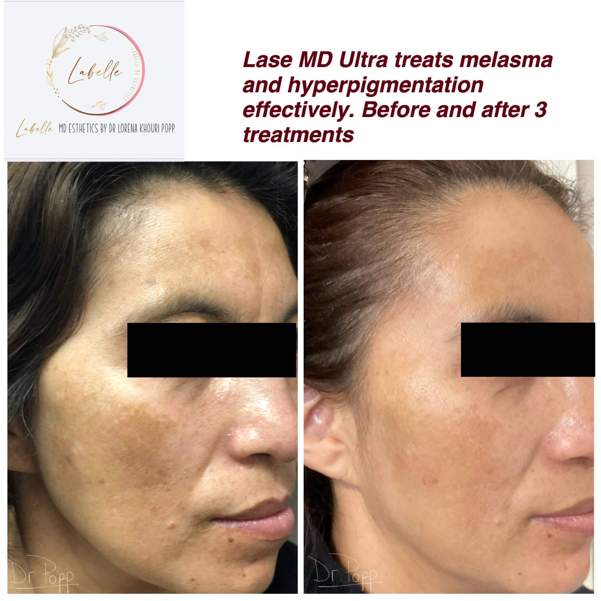 Before and After Gallery | Labelle MD Esthetics | Dr. Lorena Popp