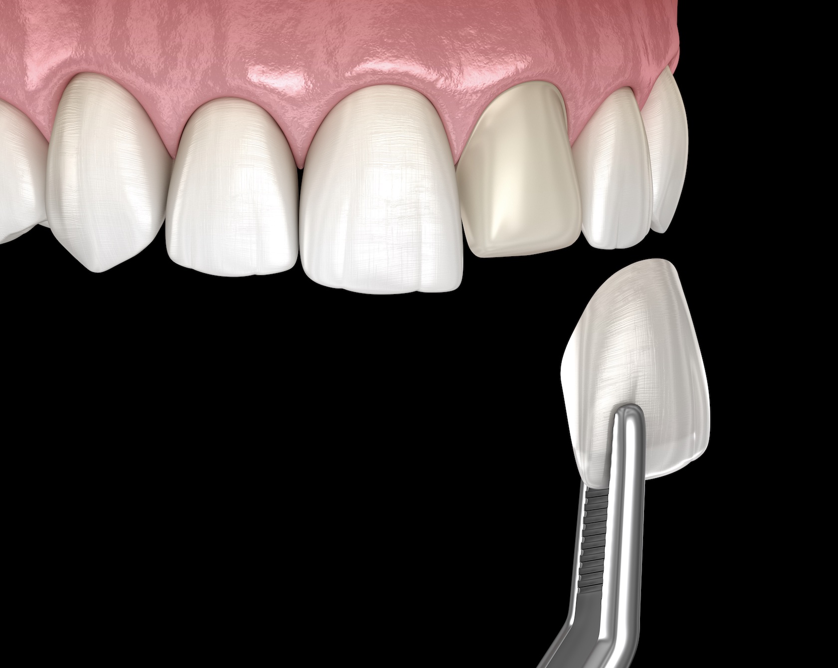 Skallfasetter - Lyngdal Tannlegesenter