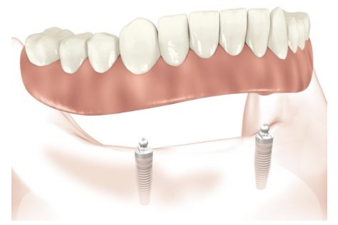 Protetisk behandling