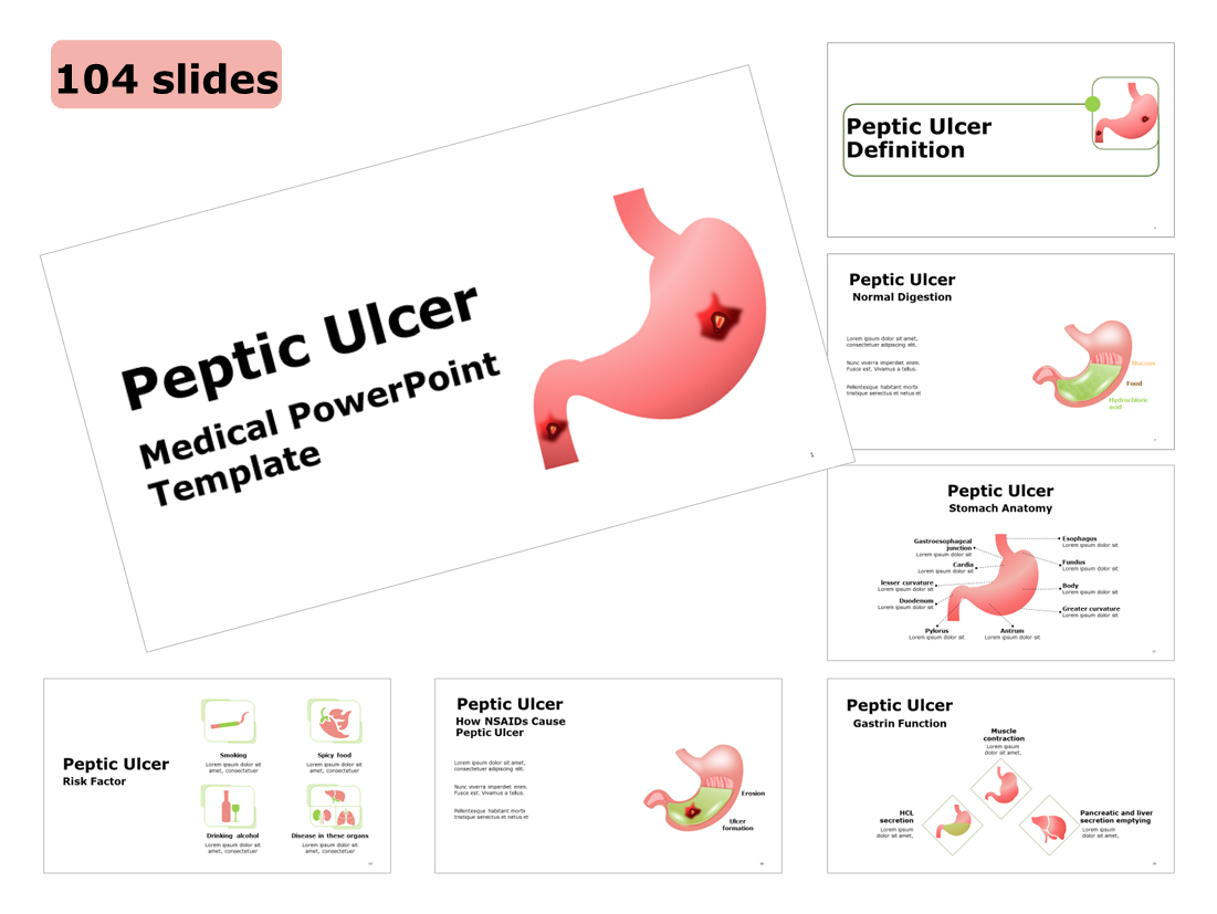 Peptic Ulcer PowerPoint Template - RxSlides - The largest online store ...