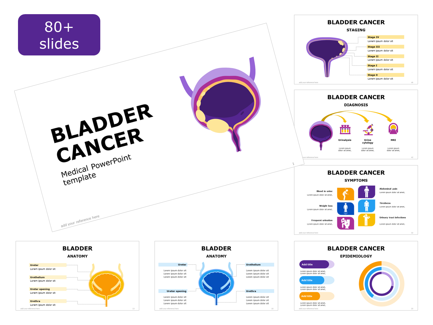 Bladder Cancer PowerPoint Template - RxSlides - The largest online store for medical PowerPoint ...