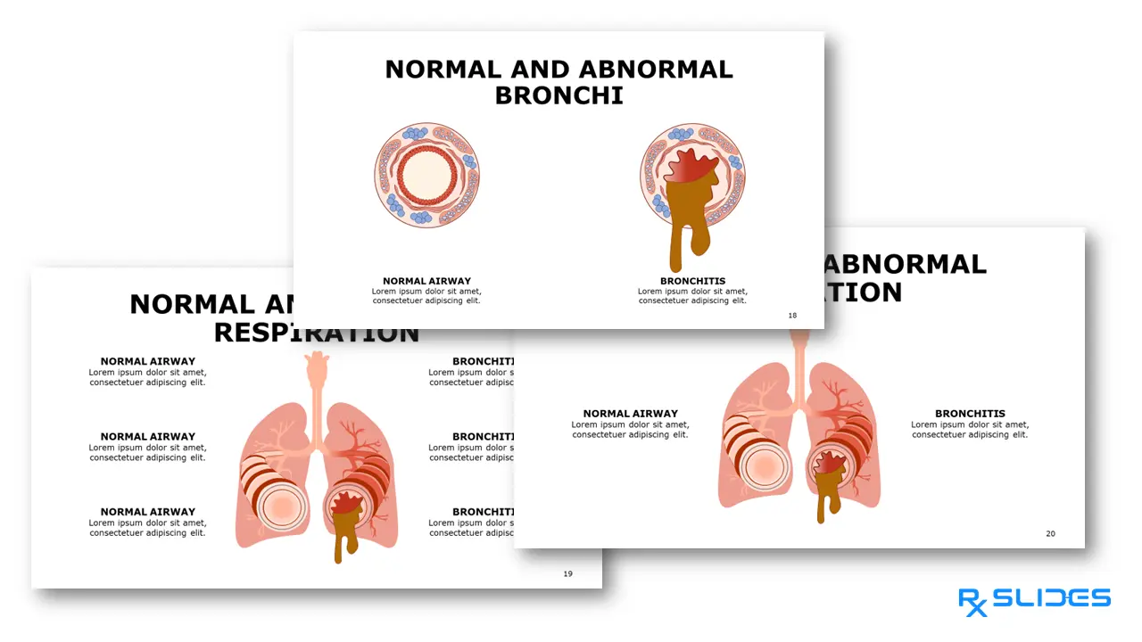 Bronchitis PowerPoint Template - RxSlides - The largest online store for medical PowerPoint ...