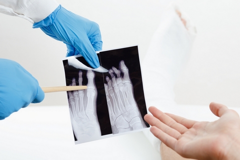8 Common Signs and Symptoms of Broken Bones