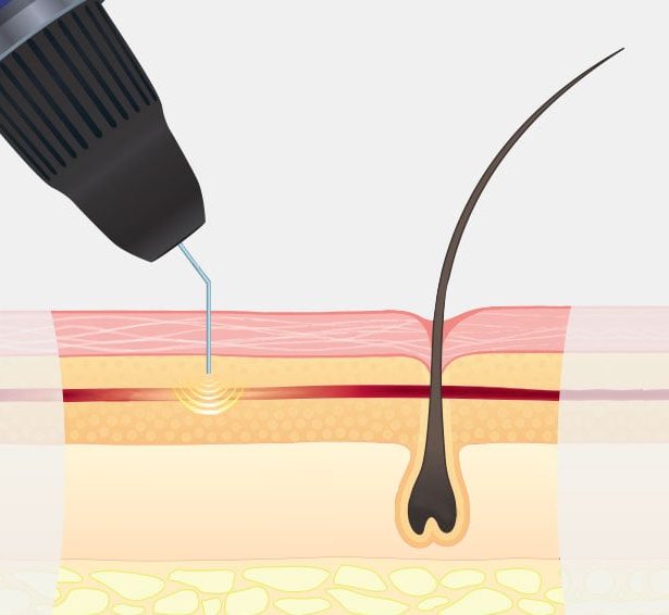 Dr Newmans Clinic | Vein Treatment | Thermocoagulation