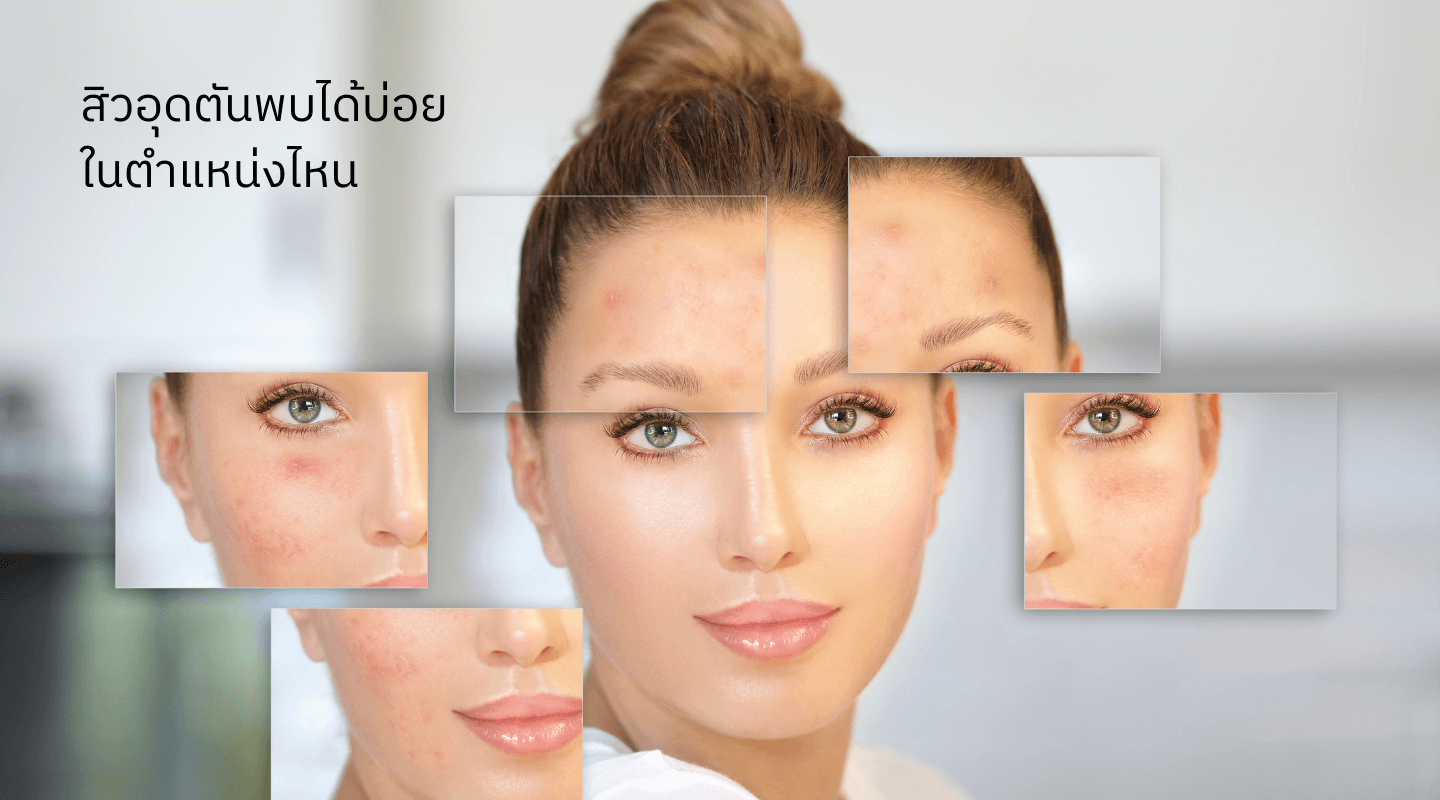 สิวอุดตัน (Comedones) สาเหตุเกิดจากอะไร? พร้อมวิธีรักษา