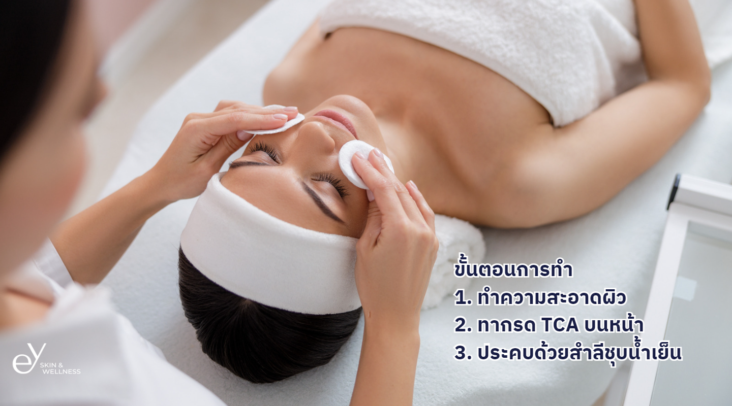 เผยพลังของ TCA Peeling ตัวช่วยฟื้นฟูผิวและสร้างคอลลาเจน