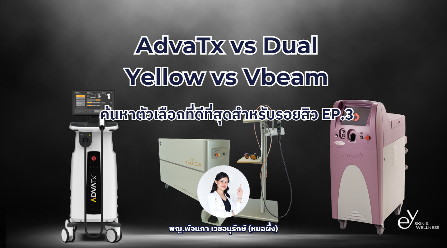 AdvaTx vs. Dual Yellow vs. Vbeam สำหรับการรักษาสิว
