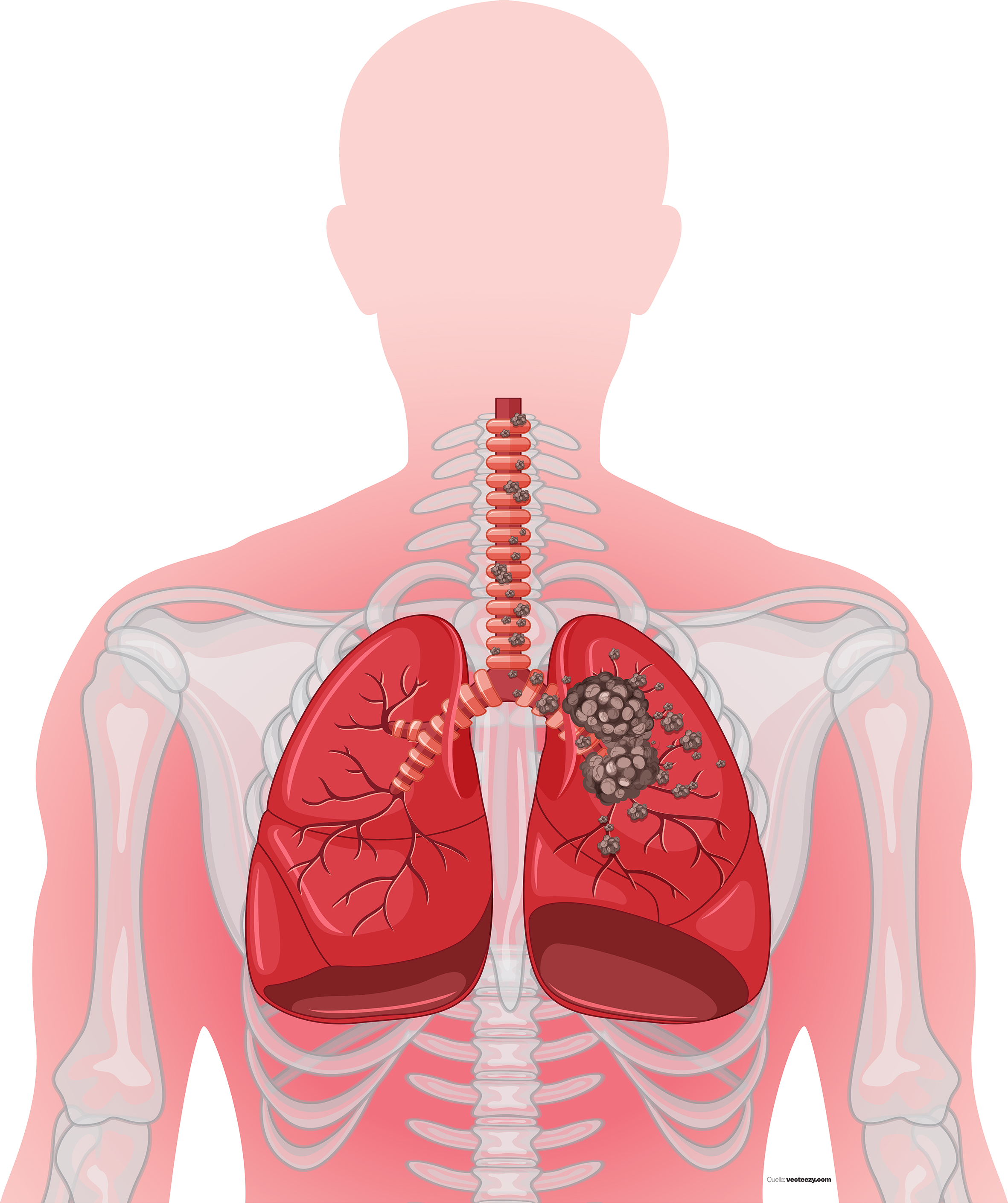 Les différents stades d’évolution du cancer du poumon