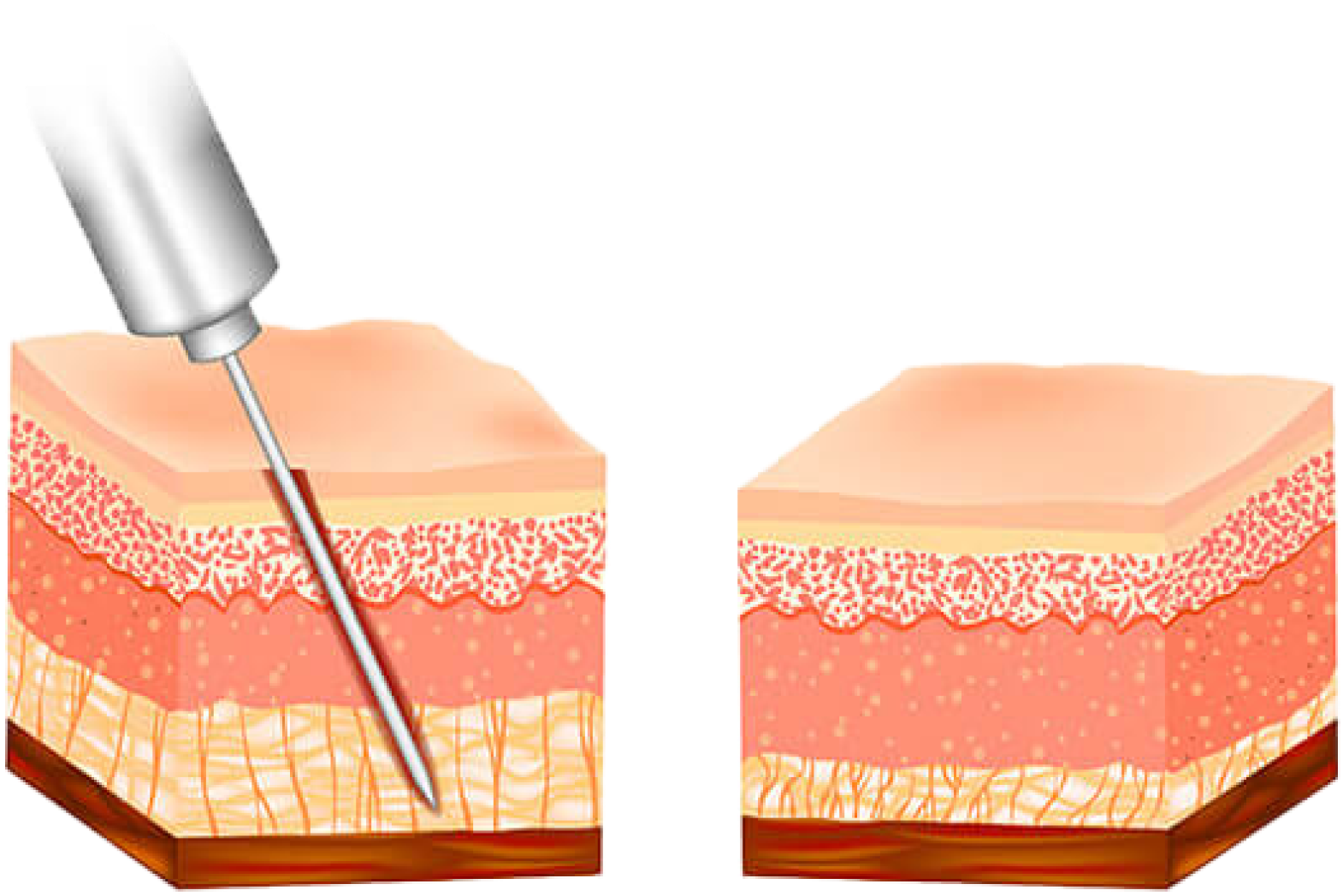 Liposuction - Body Contouring | SixSurgery