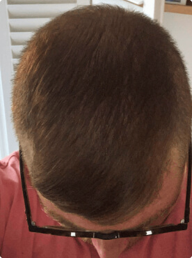 Complete Hair Loss Spray